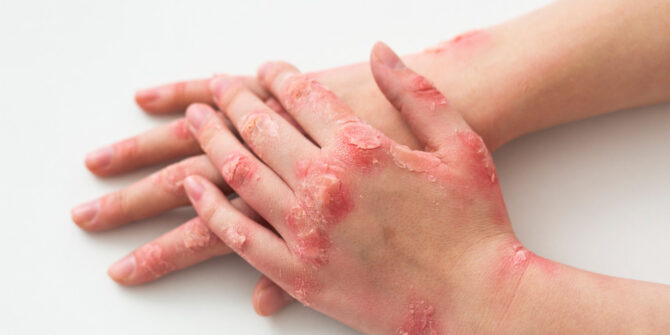Basal Cell Carcinoma Stages - Skin Cancer