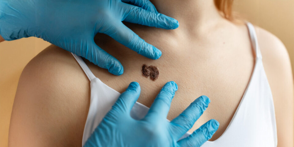 Merkel Cell Carcinoma Treatment, Symptoms, Causes & Diagnosis